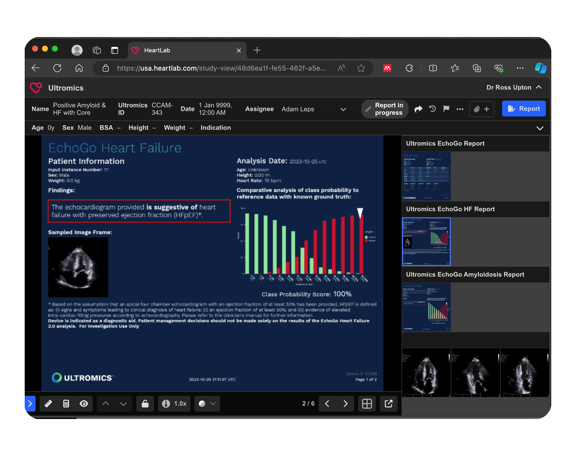 Next-generation Echocardiography is here - Ultromics